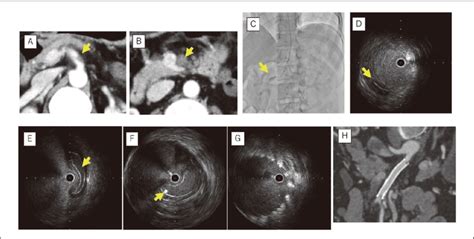 A B Ct Shows The Proximal Occlusion Of The Sma Arrow C
