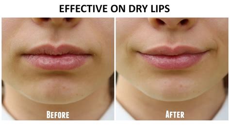 Will Vicks Vaporub Help Chapped Lips Lipstutorial Org