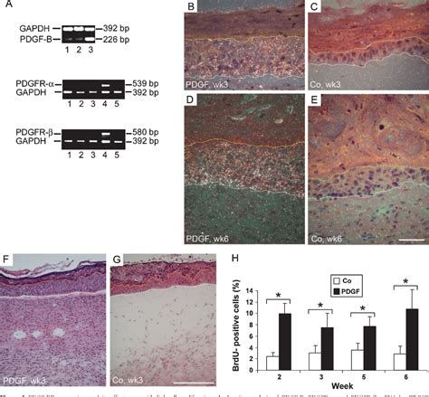 Figure 1 From Tumorigenesis And Neoplastic Progression Platelet Derived Growth Factor Bb