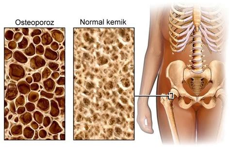 OSTEOPOROZ KEMİK ERİMESİ Prof Dr Levent Altınel Antalya