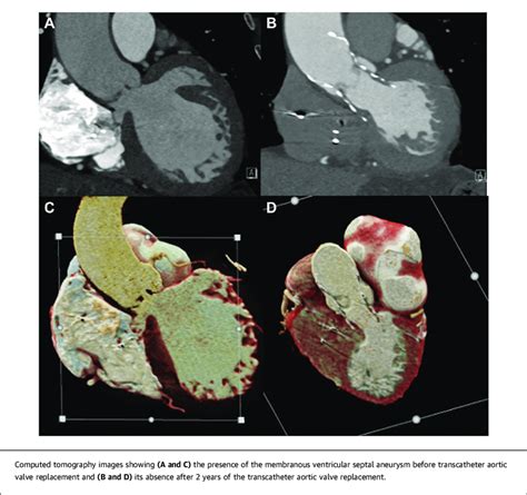 Cardiac Multidetector Computed Tomography Of The Membranous Ventricular
