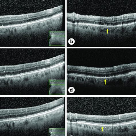 Spectral Domain Oct Cuts Showing Hyperreflective Lesions Of The Left Download Scientific