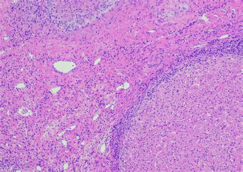 Focal Nodular Hyperplasia Liver