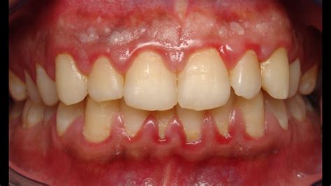 Gum Disease 4 Times As Common In Rheumatoid Arthritis Patients