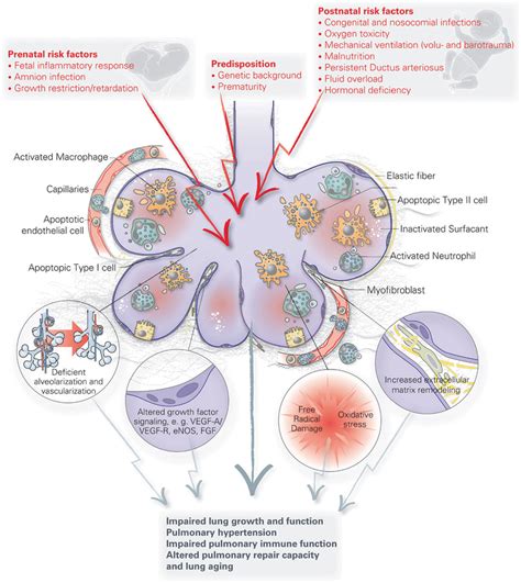 A Schematic Overview Of The Pathophysiology Of Bronchopulmonary