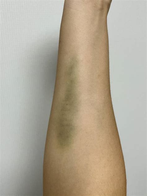 혐오주의 주사 맞을때마다 혈관이 터지는데 인스티즈 Instiz 일상 카테고리