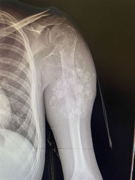 Osteosarcoma Of The Humerus In A 20 Year Old Boy Treated With Intra