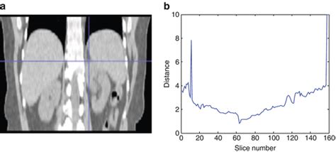 Cortex Segmentation On Computed Tomography Radiology Key