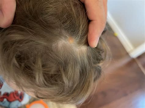 Anyone Know What This Is On My 2 Year Old Sons Head R