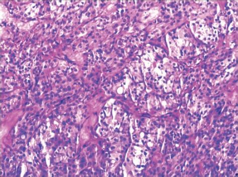 Photomicrograph Showing Neoplastic Cells Arranged In Solid Sheets