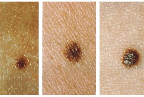 Cancerous Mole Vs Normal Mole