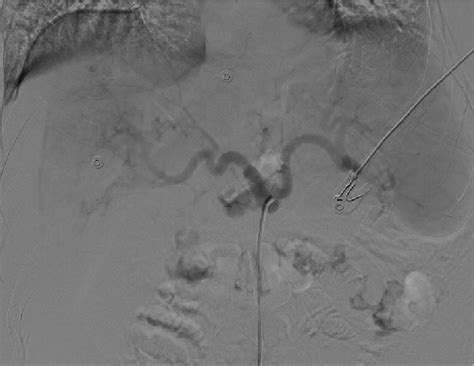 Ultrasound Guided Coil Embolization Of Small Bowel Ectopic Varix