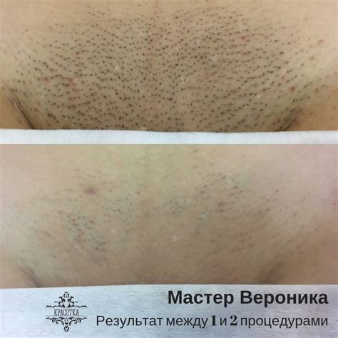 Лазерная эпиляция стоимость бикини Лазерная эпиляция бикини глубокое