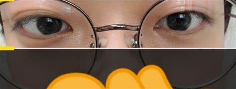 블라인드 블라블라 눈 다래끼 병원간다 약국간다 빨리빨리