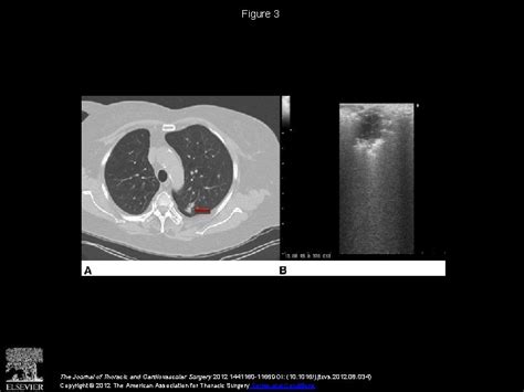 Thoracoscopic Localization Of Intraparenchymal Pulmonary Nodules Using Direct