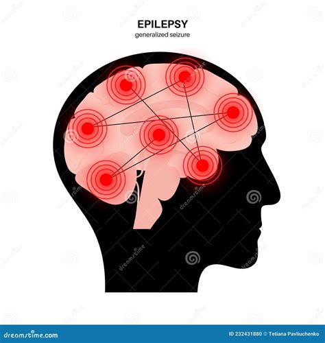 Epilepsy Central Nervous System Disorder Brain Activity Hand Drawn
