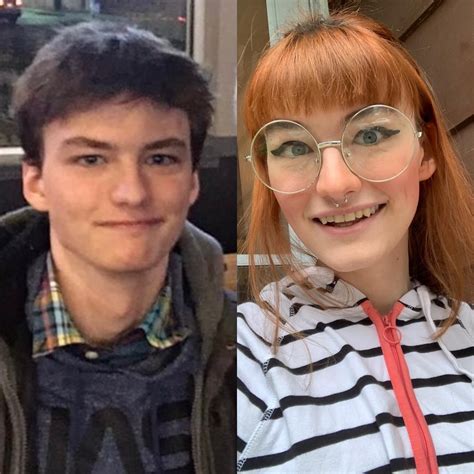 Mtf 15yr Hrt 27yo In 1 Week Bottom Surgery In 5 Day Rtranstimelines