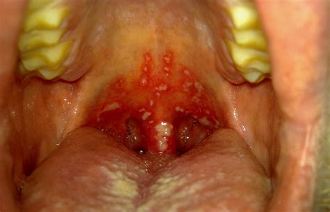 Herpes Labialis Cold Sore
