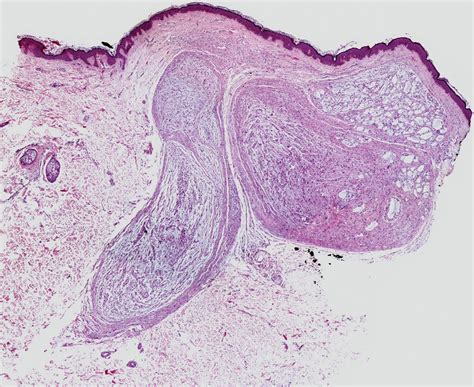 Plexiform Neurofibroma Histopathology
