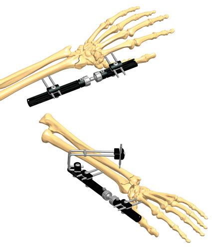 Internal Fixation Vs External Fixation Orthofix
