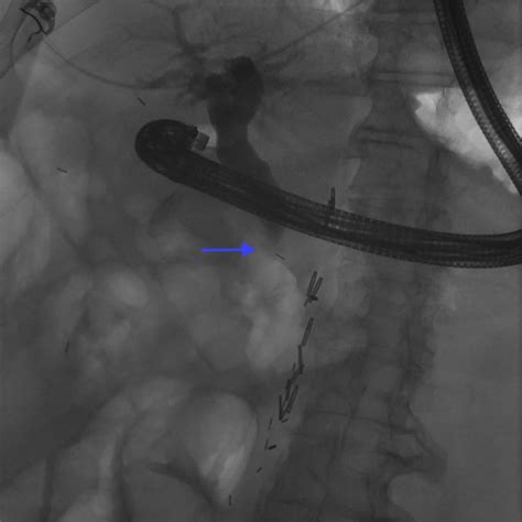 Pdf Eus Guided Choledochoduodenostomy Creation Using A Biliary Fully Covered Self Expanding