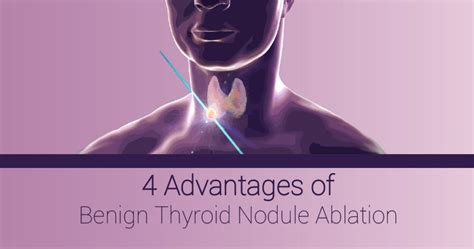 Benign Thyroid Nodule Ablation Uva Radiology And Medical Imaging