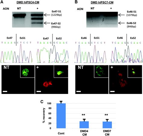 Exon Skipping And Gene Transfer Restore Dystrophin Expression In Human