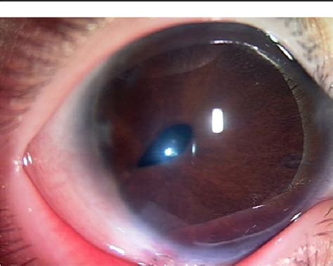Congenital Ectopic Pupil Semantic Scholar