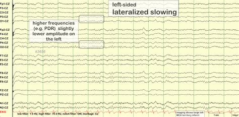 Focal Or Lateralized Slowing