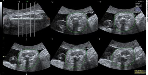 Figure 1 From Correlation Of Fractional Limb Volume Measurements With Neonatal Morphometric