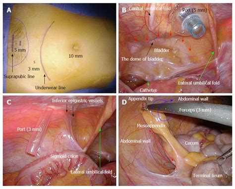 How Much Does An Appendix Surgery Cost In Nigeria Public Health