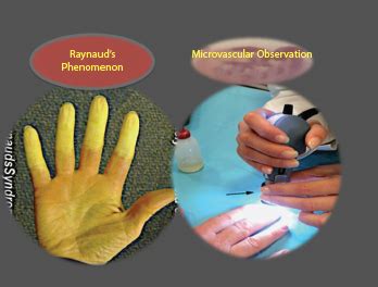 Rheumatologists Find Nailfold Capillaroscopy An Increasingly Useful