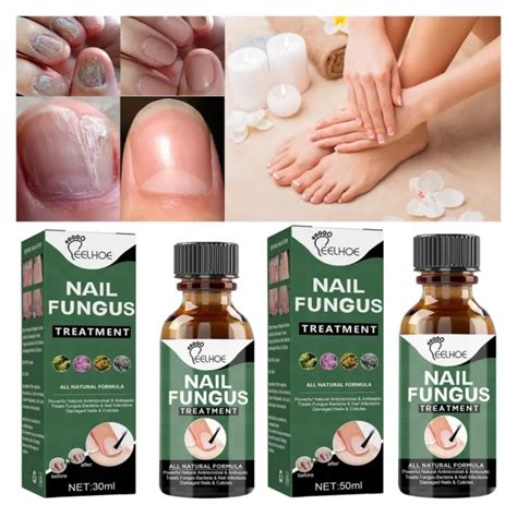 Anti Fungal Treatment Extra Strength Toenail Fungus Athletes Foot Fungi