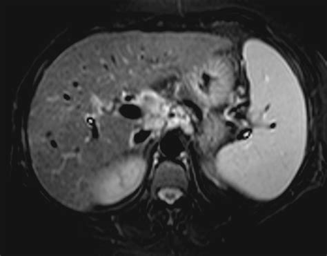 Reactive Lymph Node Transverse Stir Image Shows Lymphadenopathy At The