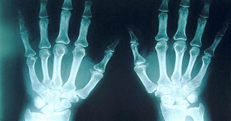 Artritis Y Artrosis ¿cuál Es La Diferencia Entre Ambas Y Cómo Afectan