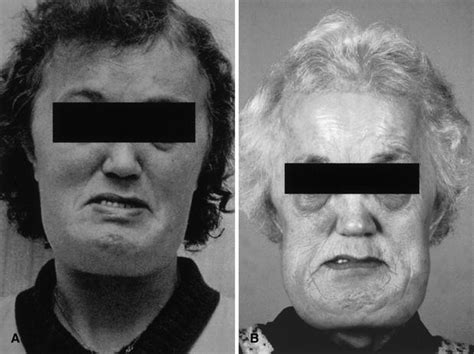 Sindrome Di Van Buchem