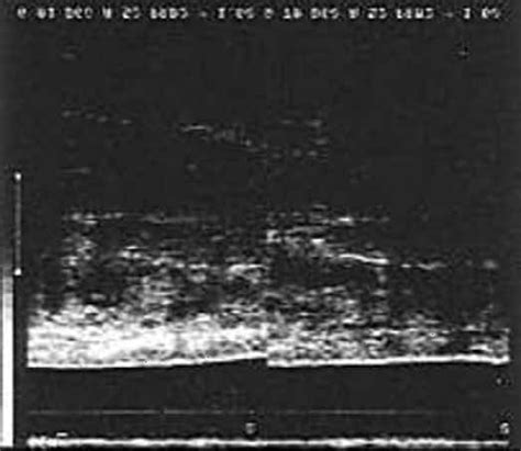Conservatively Treated Partial Rupture Twelve Weeks After Injury