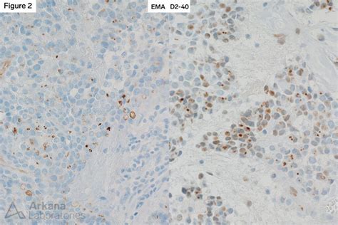 Ependymoma Spinal Cord Lesion