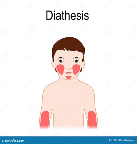Atopic Dermatitis Eczema And Normal Skin Cell Illustration Healthy