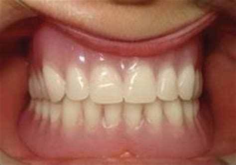 Suhasis Online Ectodermal Dysplasia With True Anodontia