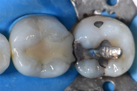 Simple Shade Selection Composite Resin Kerr Simplishade
