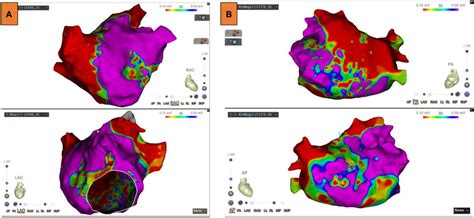 Low Voltage Areas Lvas Of The Left Atrium La A Lvas Were Download Scientific Diagram