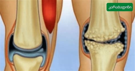 6 ბუნებრივი ანთების საწინააღმდეგო საშუალება რომლებიც სასწაულებს ახდენს სახსრებისა და მუხლის