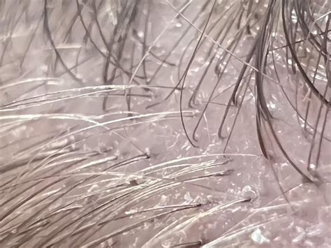 Silver Scalp Scale R Dermatologyquestions