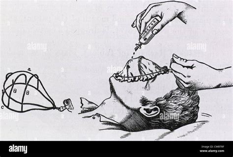 Chloroform Anesthesia