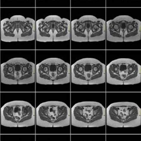 Axial Fast Spin Echo Fse T1 Weighted Sequence In Pelvic Magnetic