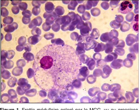 Figure 2 From Niemann Pick Disease A A Case Report Semantic Scholar