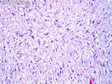 Plexiform Neurofibroma