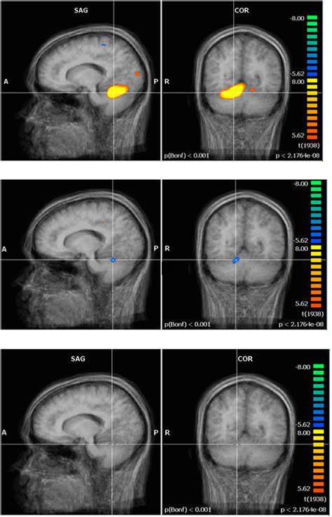 Functional Brain Activationcerebellum Cerebellum Top RowTapping