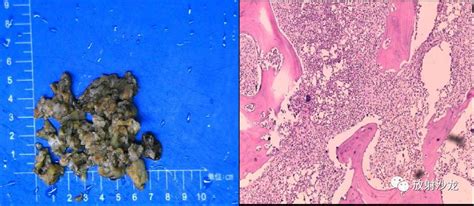 病例分析慢性化脓性骨髓炎 MedSci cn